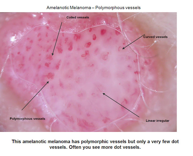 Dermoscopy Features as Clues: Clues to Melanoma