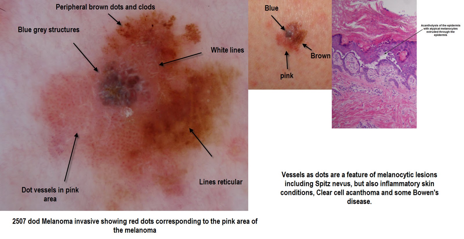 Dermoscopy Made Simple: Melanoma in situ mainly