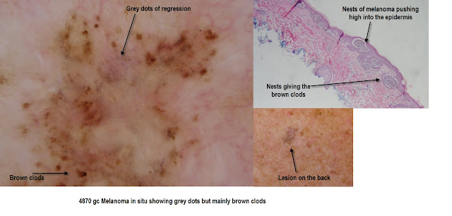 Dermoscopy Features as Clues: Clues to Melanoma