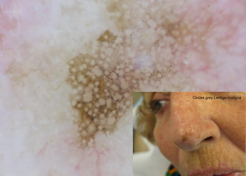 Dermoscopy Features as Clues: Clues to Melanoma