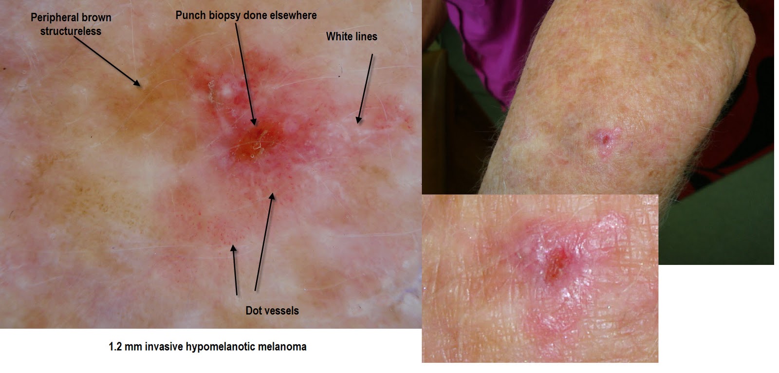 Dermoscopy Made Simple: Melanoma in situ mainly