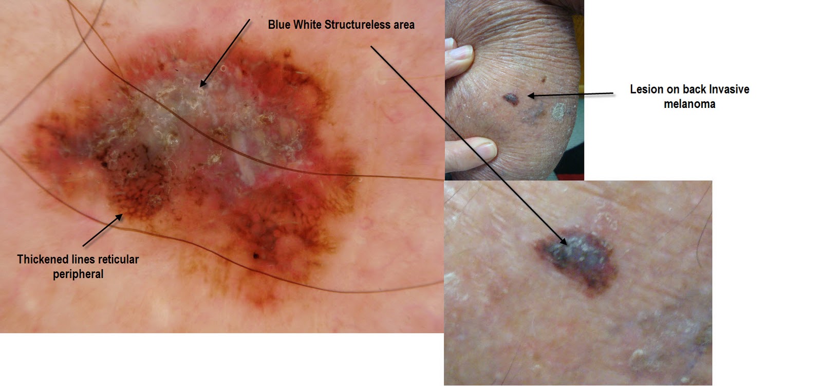 Dermoscopy Features as Clues: Clues to Melanoma