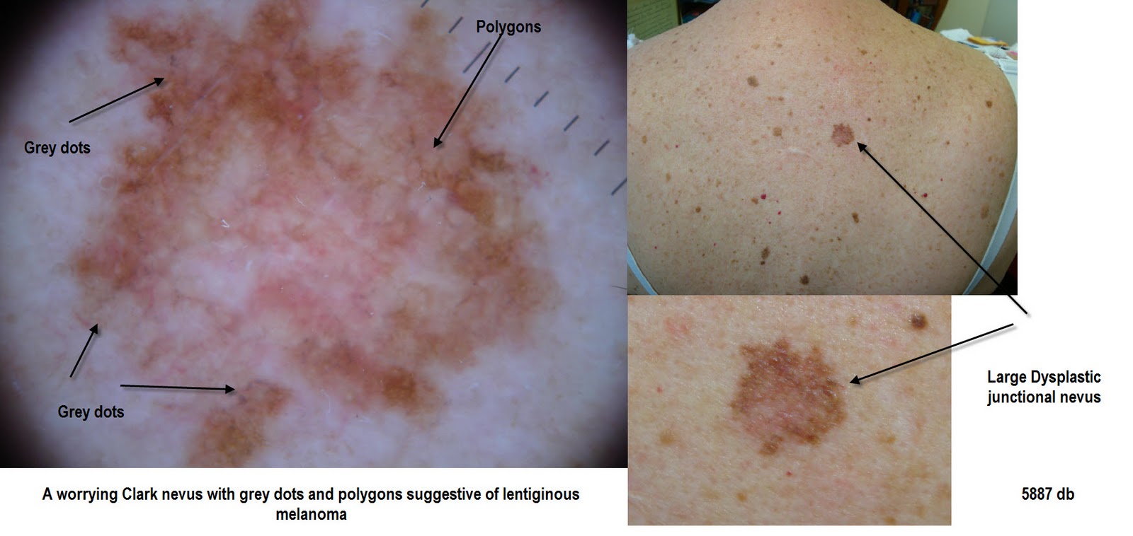 Dermoscopy Made Simple: Clark or Dysplastic nevi