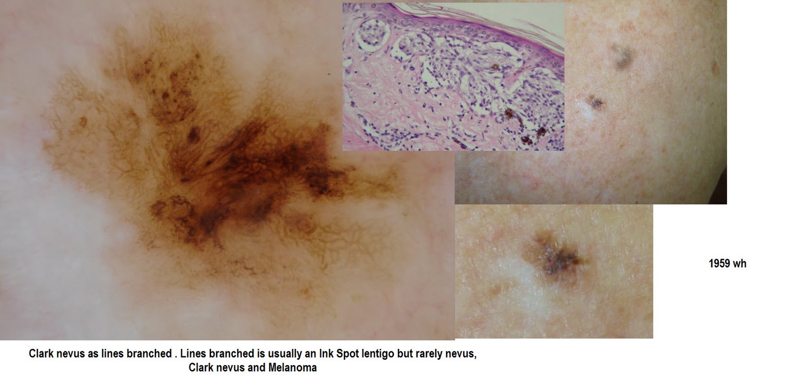 Dermatoscopy Made Simple: Clark or Dysplastic nevi