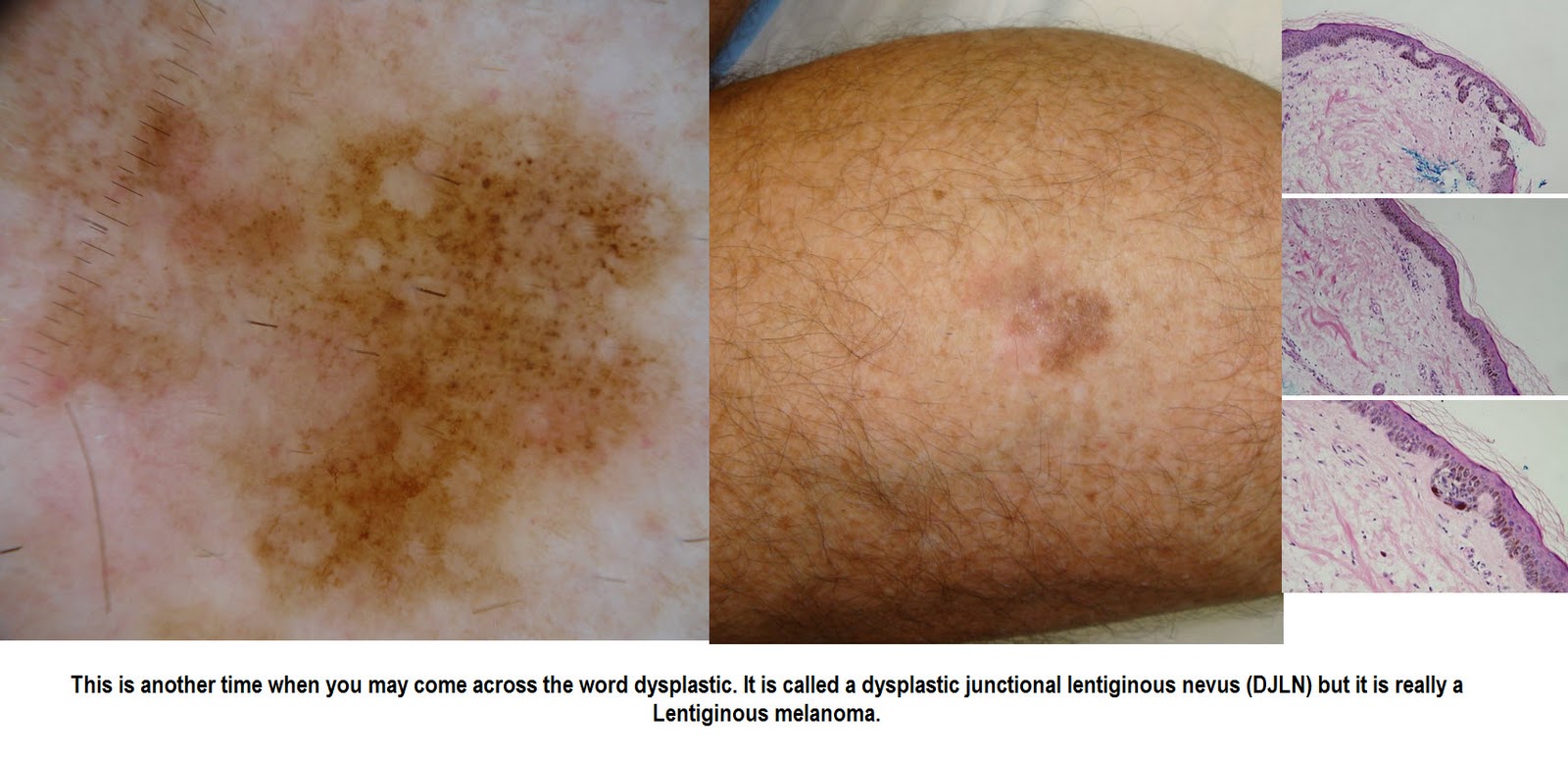 Dermoscopy Made Simple: Clark or Dysplastic nevi