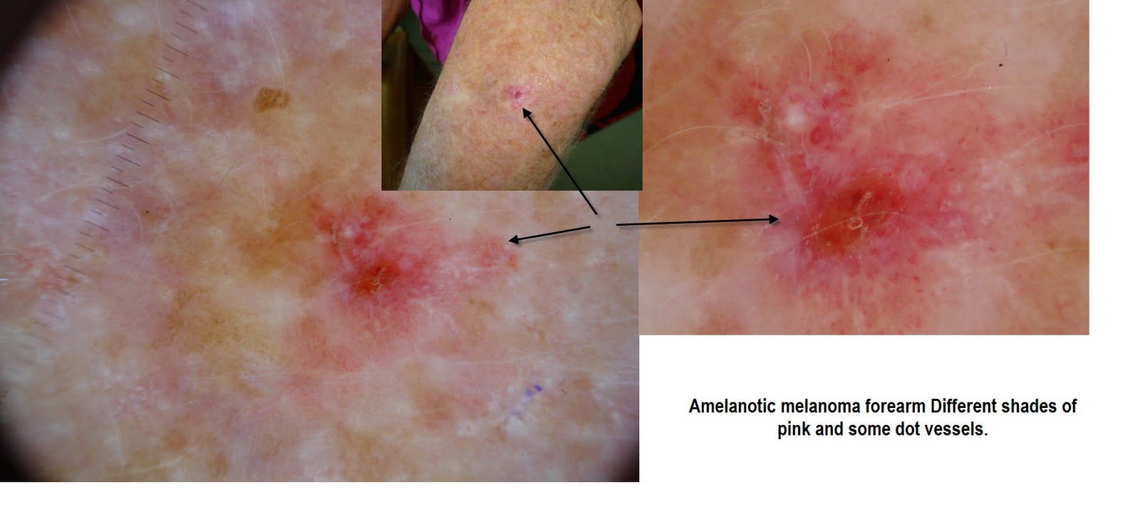Dermoscopy Made Simple: Amelanotic Melanoma