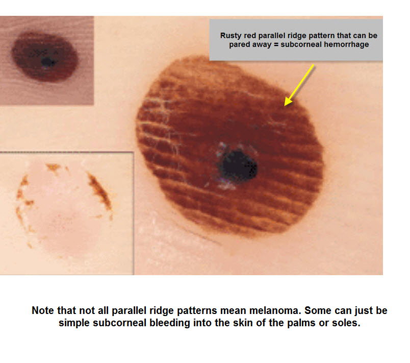 Dermoscopy Made Simple: Acral and Subungual Melanoma