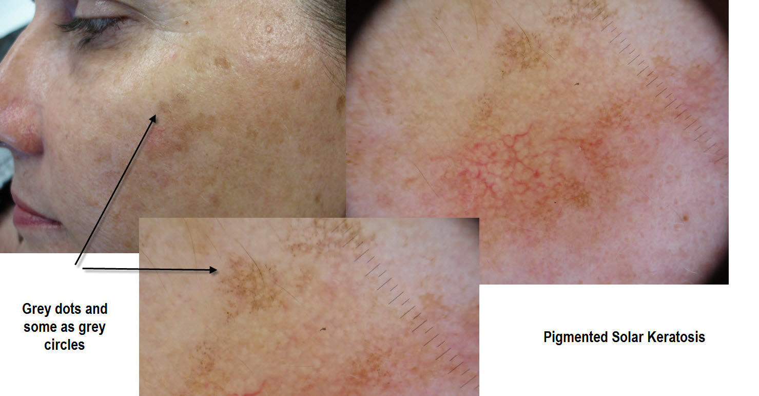Dermoscopy Made Simple: Solar keratosis