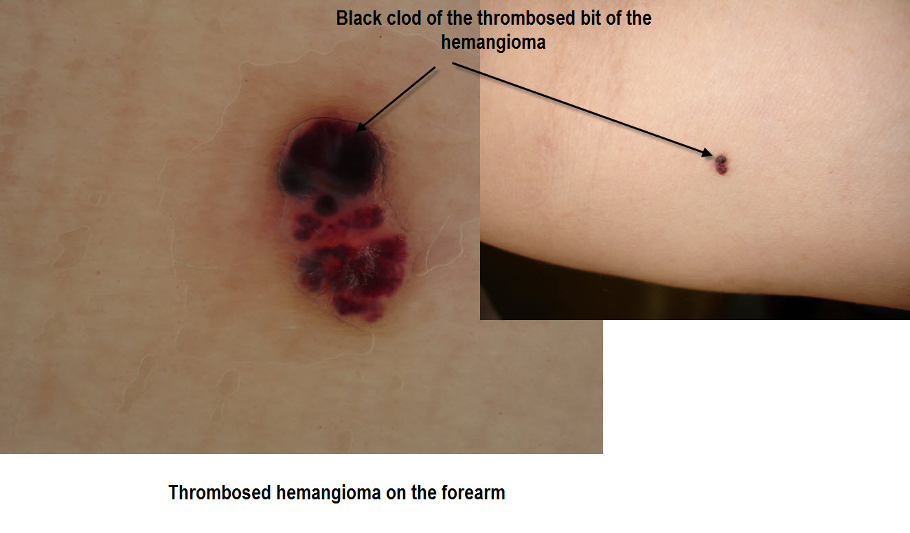 Dermoscopy Made Simple: Haemangioma and Angiokeratoma