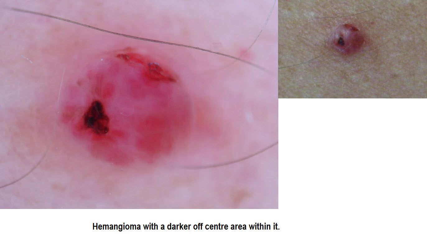 Dermoscopy Made Simple: Haemangioma and Angiokeratoma