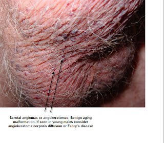 Dermoscopy Made Simple: Haemangioma and Angiokeratoma