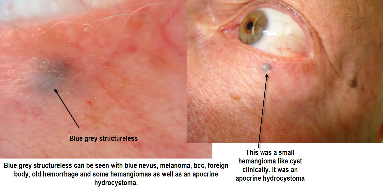 Dermoscopy Made Simple: Adnexal tumours and Foreign body