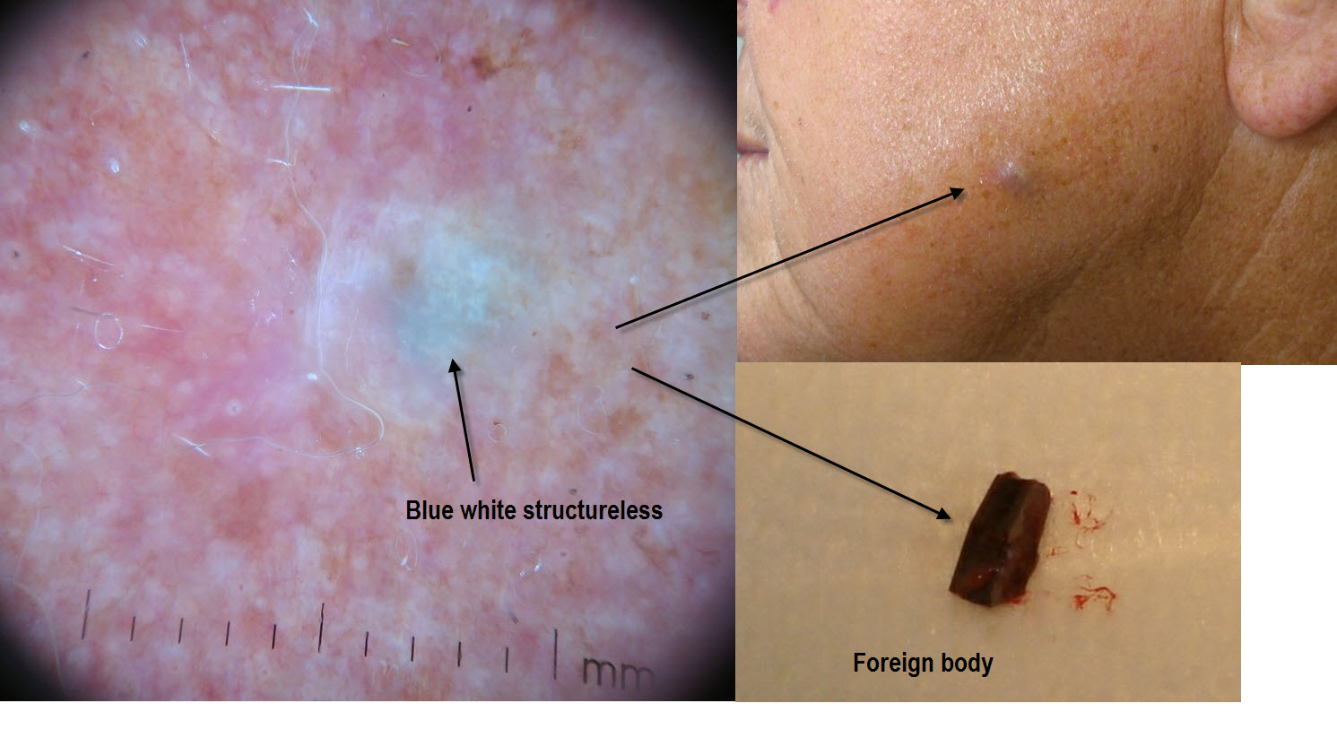 Dermoscopy Made Simple: Adnexal tumours and Foreign body