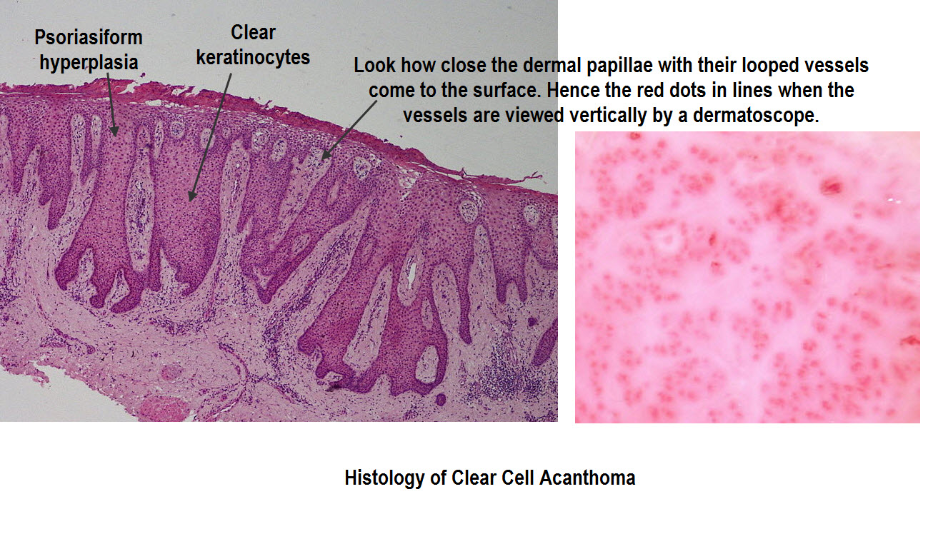 Clear Cell Acanthoma Histology