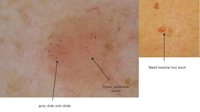 Dermoscopy Made Simple: Clods