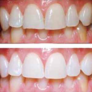 Brite Smile Whitening