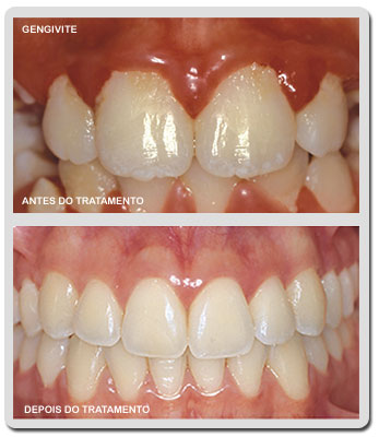 Gengivite: Gengivite