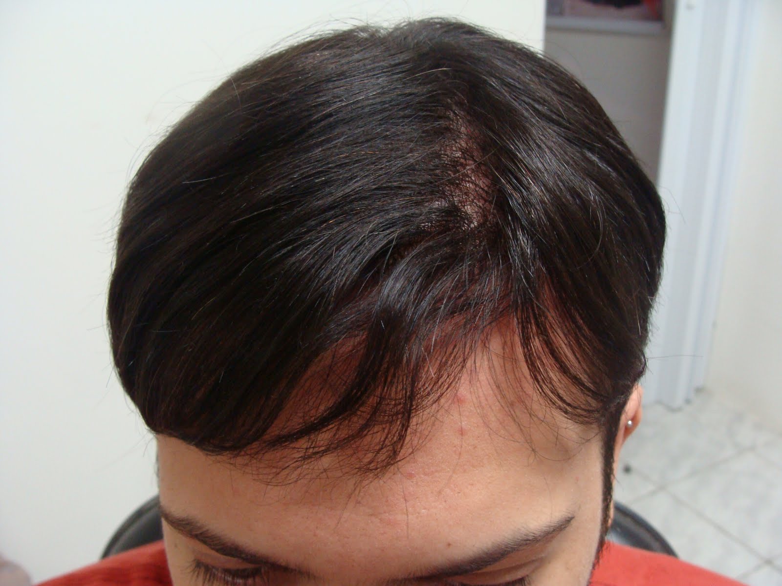 MEGA HAIR: Prótese masculina,em micro pele.