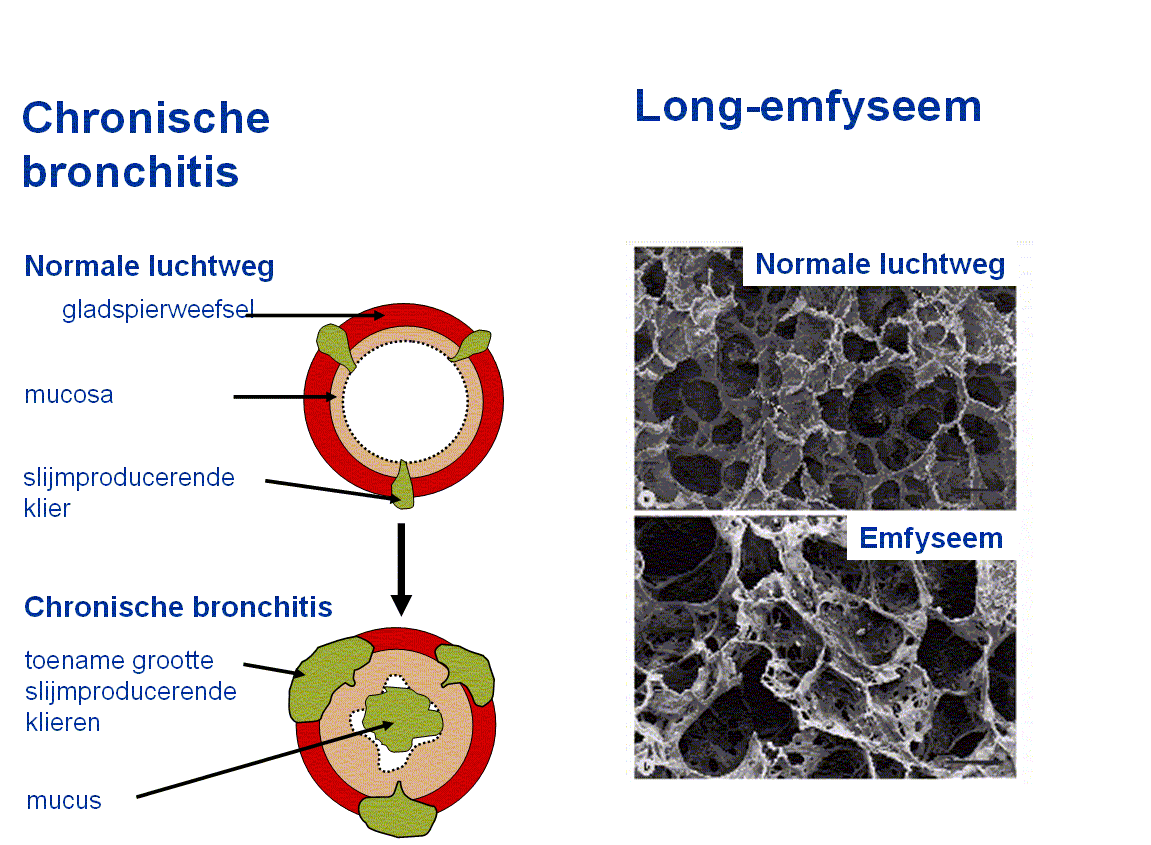 LongartsZwolle: chronische bronchitis en longemfyseem