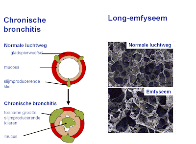 LongartsZwolle: chronische bronchitis en longemfyseem