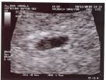 Allison & Daniel's Journey: 5 week 5 day ultrasound