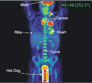 Pet Scan Test Living With Me/Cfs: Pet Imaging May Provide Diagnostic ...