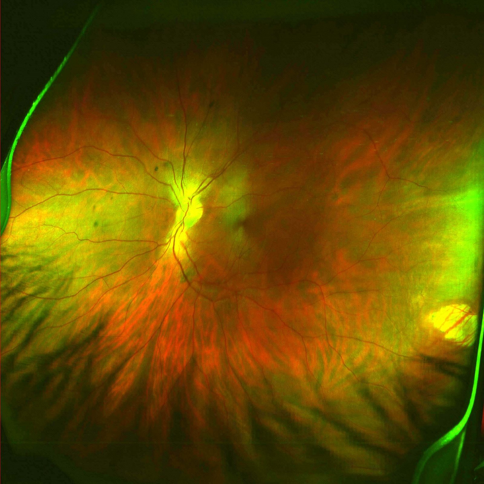 http://EyeSee-EyeTalk.blogspot.com: 2.3.3 Retinal lurkers