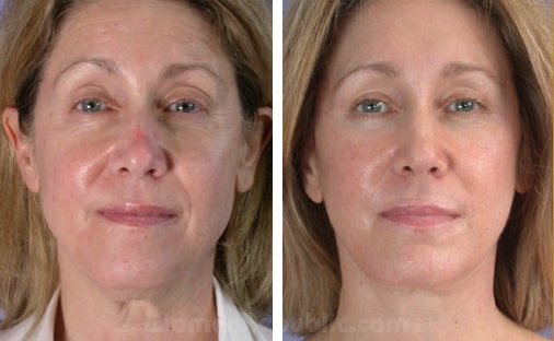 Face Lifting: Short Scar Face Lift - Rhytidectomy