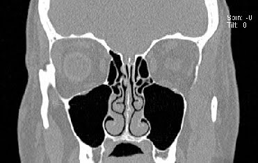 myMRI-CTblog: CHRONIC SINUSITIS