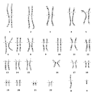 Cystic Fibrosis: Karyotype