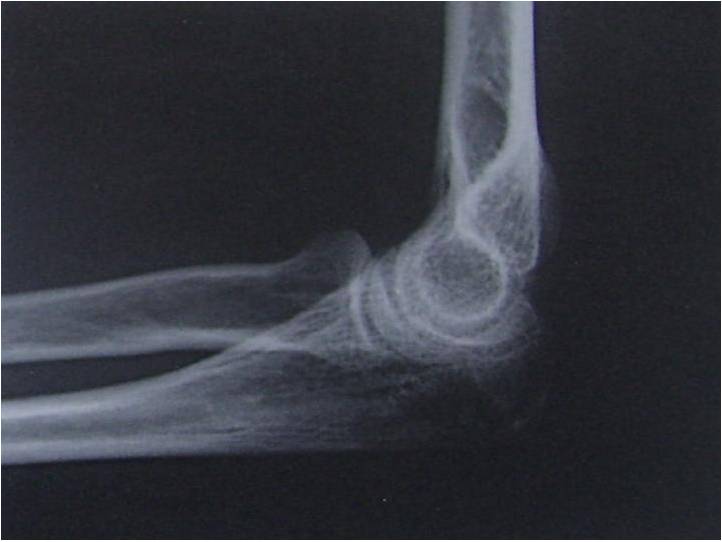 Rayos-5 ;p: CODO PROYECCION LATERAL (LATEROMEDIAL)