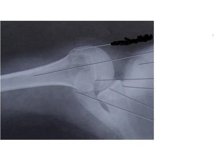 Rayos-5 ;p: ARTICULACION DEL HOMBRO PROYECCION AXIAL (INFEROSUPERIOR ...