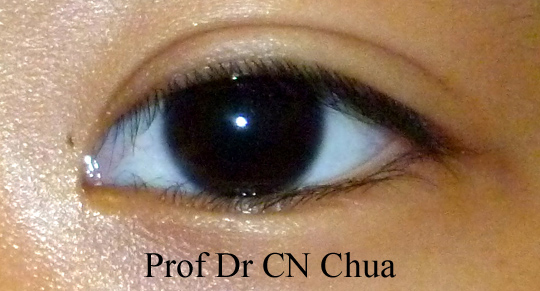 Eyelid Surgery by Prof Dr CN CHUA 蔡鐘能: The Joys and Pitfalls of Suture ...