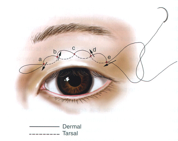Eyelid Surgery by Prof Dr CN CHUA 蔡鐘能: Different Suture Techniques for ...