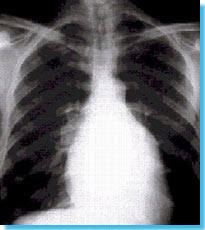 sistema respiratorio y deportes en altura: ¿Qué causa la disnea (falta ...