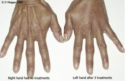 Dr Ravi Jain: Six Uses for Sculptra