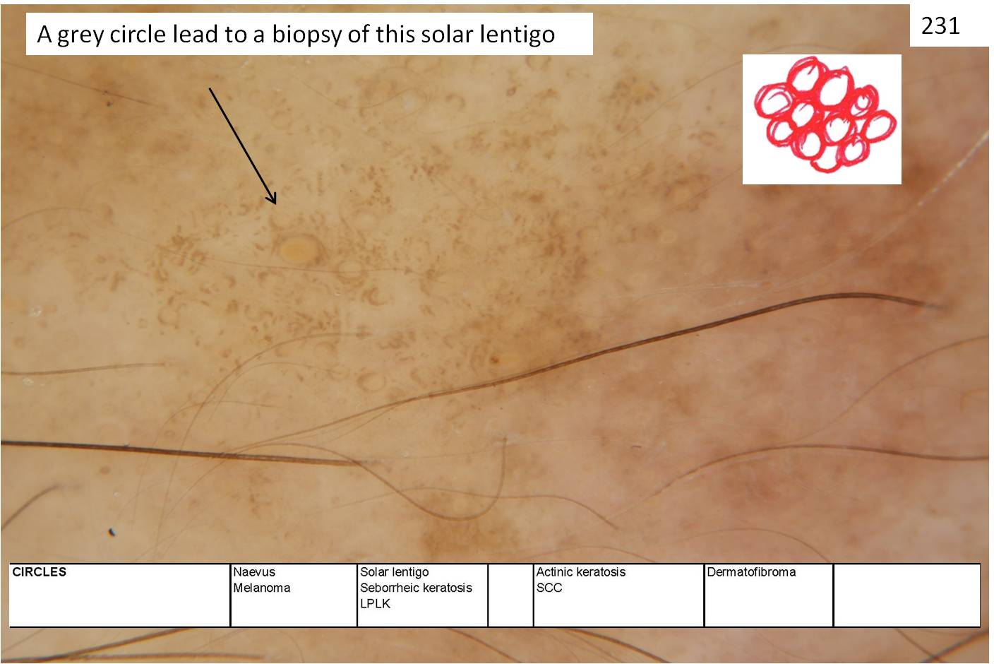 Introduction to Dermatoscopy