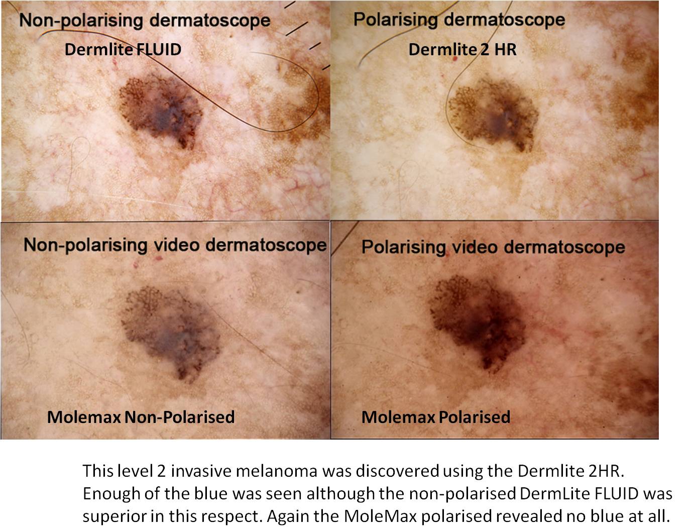 Introduction to Dermatoscopy