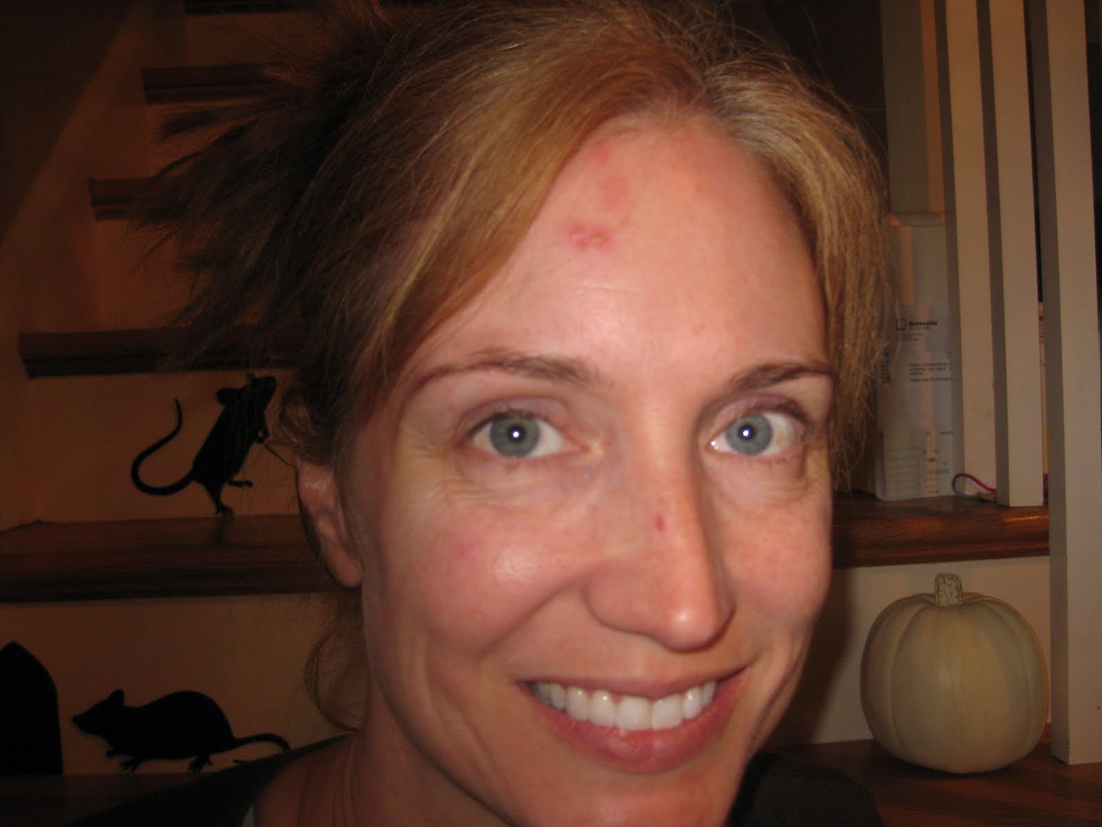 Mild Shingles On Face