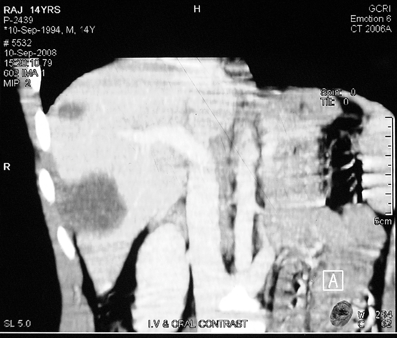 What is Radiofrequency Ablation of Liver Tumors ? ~ Radio Frequency ...