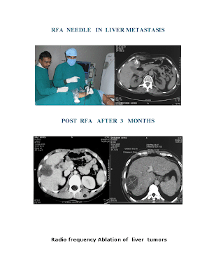 Radiofrequency Ablation of Malignant Liver Tumors - RF Ablation Liver ...
