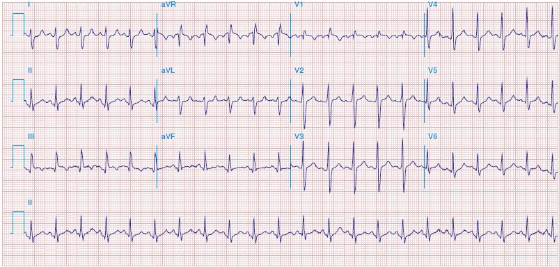 Blog do ECG: TROMBOEMBOLISMO PULMONAR: ACHADOS ELETROCARDIOGRÁFICOS