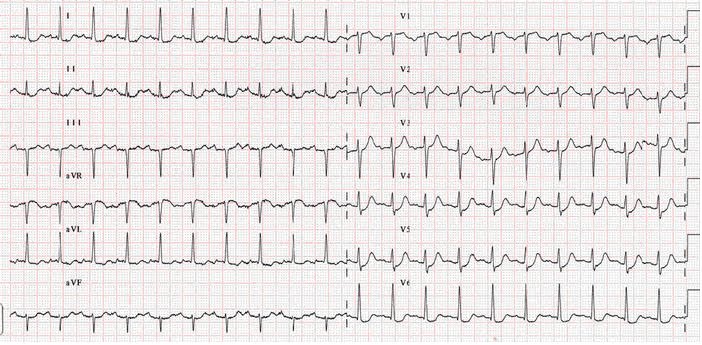 Blog do ECG: ARRITMIAS CARDÍACAS SINUSAIS: ECG DE TAQUICARDIA SINUSAL