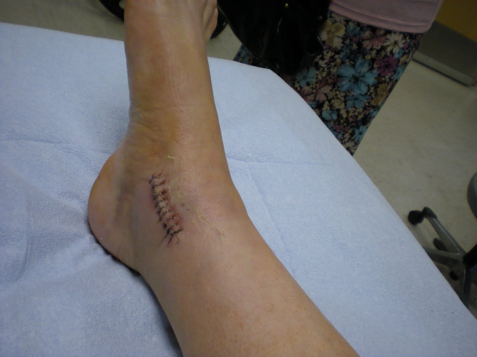 Broken Ankle: 2 Weeks after Surgery. Removal of staples