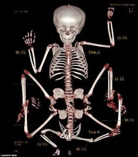 All The Facts At One Place: Girl born with 4 Arms & 4 Legs