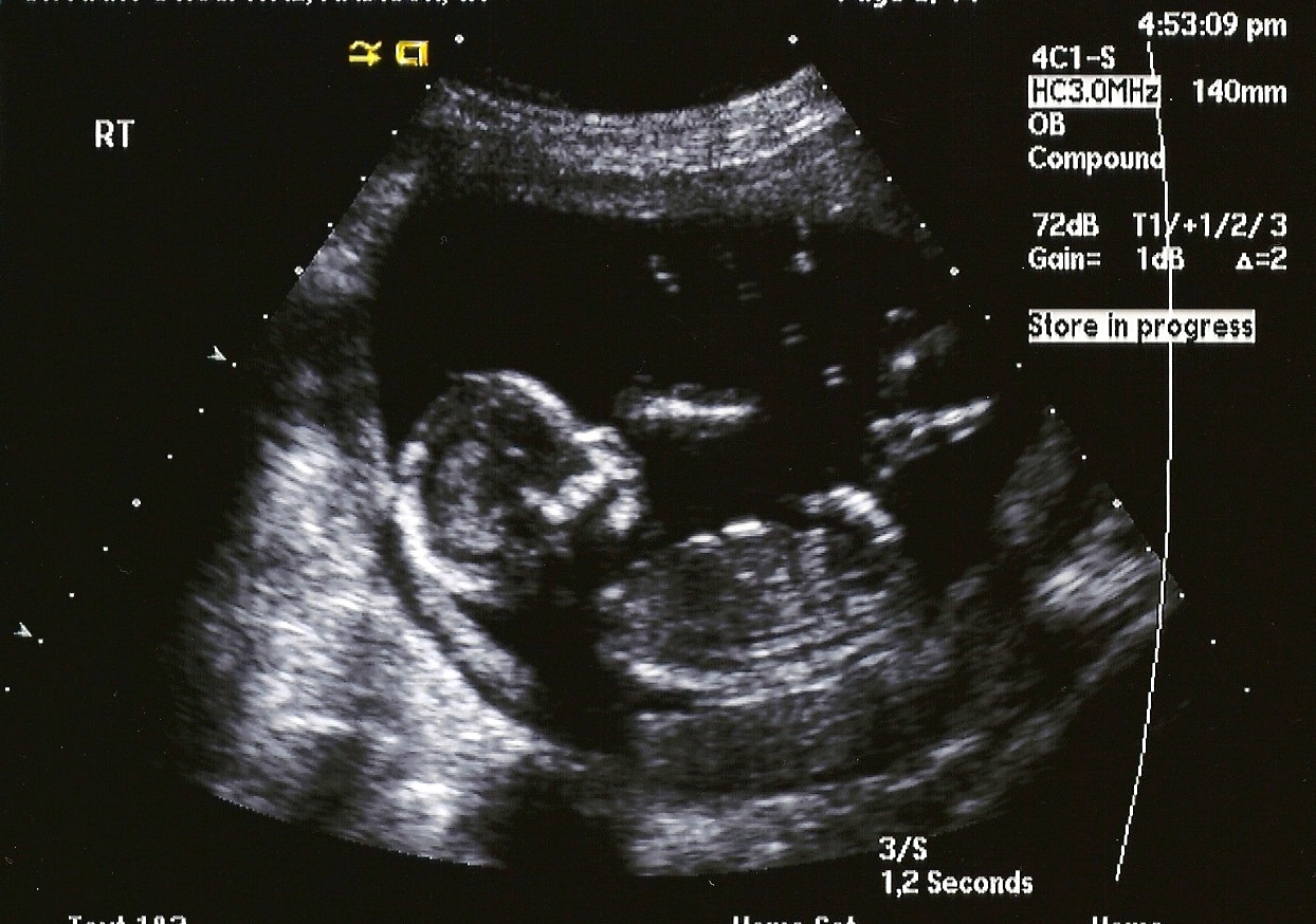 Smithback Twins: 16 Week Ultrasound Pictures!