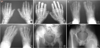 CIPA: La Insensibilidad congénita al dolor con anhidrosis o CIPA ...