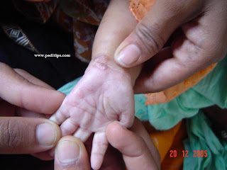 medical pics: infantile scabies scabies in infant vulgar scabies ...