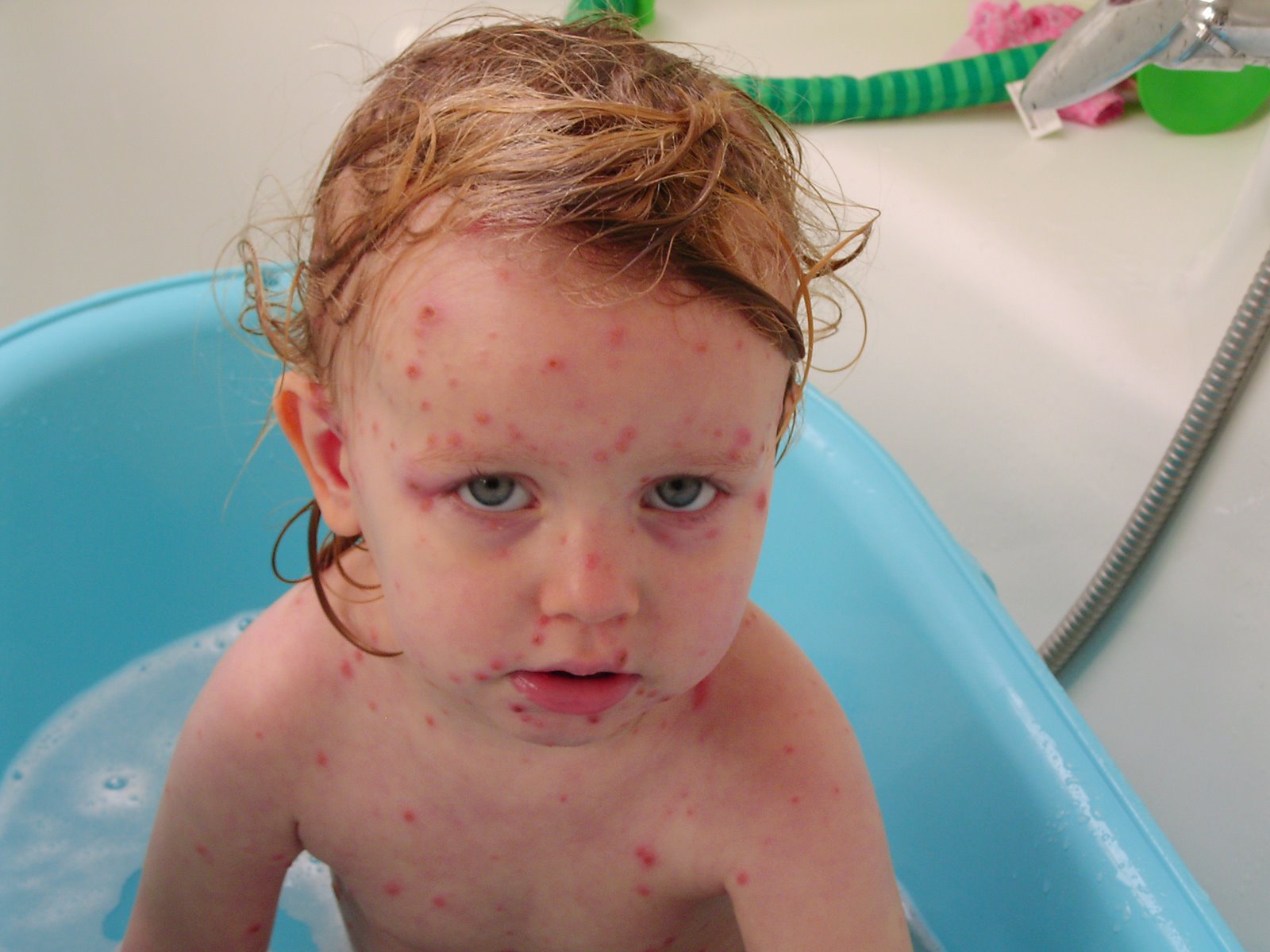 Emmie...et compagnie: Début de la varicelle. No comment!