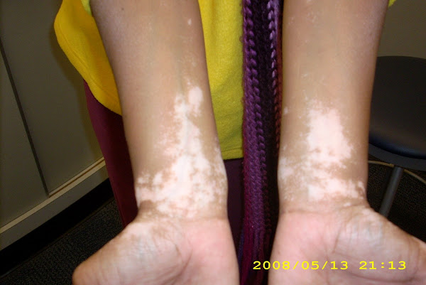 Love, Laugh, and Living with Vitiligo: Invasion of the White Patches